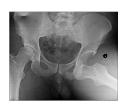 Hip Dislocation Pptx Ppt