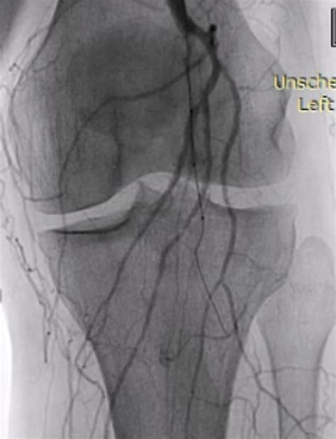 Achieving Success In Calcified Sfa And Popliteal Lesions Endovascular Today