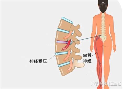 臀部疼痛，这4个位置代表不同的问题，医生教你分辨 知乎