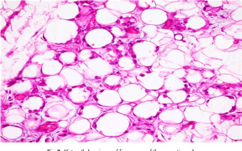 A Rare Case Of Liposarcoma Of The Spermatic Cord Semantic Scholar