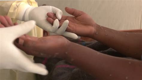 Nouveau variant du virus Mpox la France prête pour la variole du singe