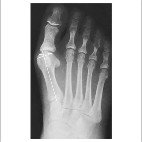 Triplane Hallux Valgus Classification And Treatment Anatomic Based Download Scientific Diagram