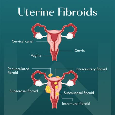 Uterine Fibroids And Menopause Symptoms Causes And Treatments