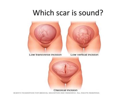 Previous Cesarean Section Pptx
