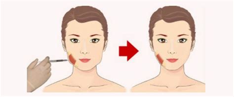 Jaw Reduction A Perfect Solution To The Rough And Square Jawline