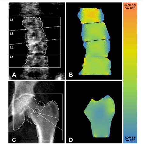 An Example Of Lumbar And Femur Dxa Scans A And C Respectively With