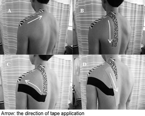 Figure 1 From Effects Of Scapula Upward Taping Using Kinesiology Tape In A Patient With Shoulder