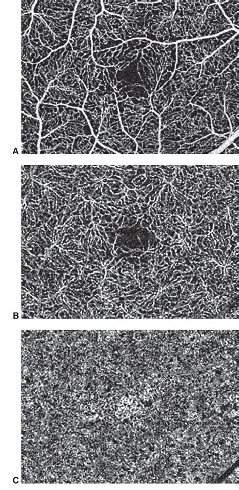 Optical Coherence Tomography Angiography American Academy Of