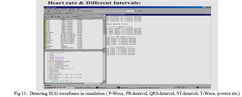 Identification Of Cardiac Arrhythmia With Respect To Ecg Signal By Neural Networks And Genetic