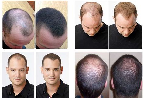 МИНОКСИДИЛ для волос КУПИТЬ в Эстонии Цена в аптеке