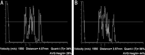 An Optic Nerve Diameter Arachnoid Archnoid 4 07 Mm In Primary Download Scientific Diagram