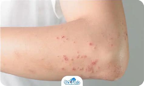 حساسیت پوستی چیست؟ بررسی بهترین روش درمان این عارضه