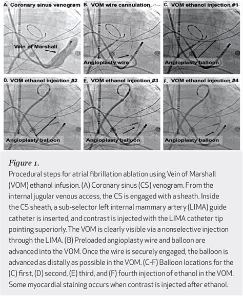 Figure 1 From Atrial Fibrillation Ablation Using Vein Of Marshall Ethanol Infusion Semantic