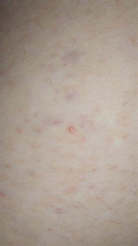 Can Kp Cause Swelling R Keratosis