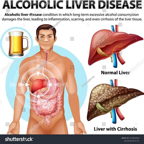 Informative Poster Alcoholic Liver Disease Cirrhosis Stock Vector