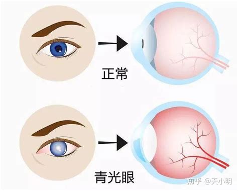 致盲病因主要有哪五种眼病？ 知乎