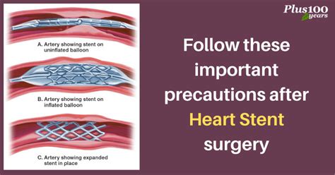 Follow These Important Precautions After Heart Stent Surgery Plus100years