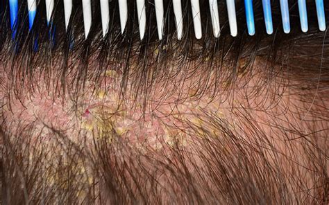 Scalp Eczema Causes Symptoms Treatments And Preventive Tips Vedix