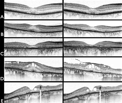 Spectral Domain Optical Coherence Tomography Follow Up In Chloroquine