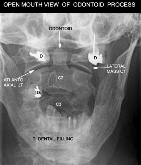 Identify The Odontoid Process Click The Image For Labeling