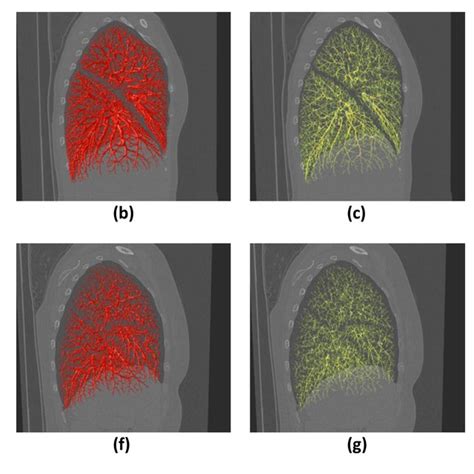 The Pulmonary Vascular Morphology Of Two Patients In Ssc Were