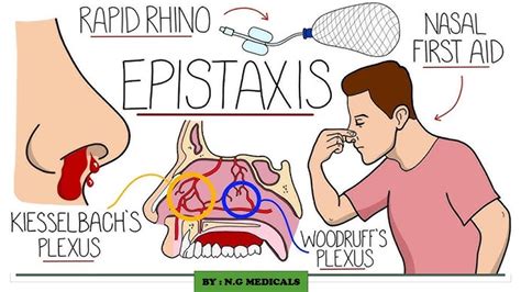 Epistaxis Nose Bleeding Ngmedicals Youtube