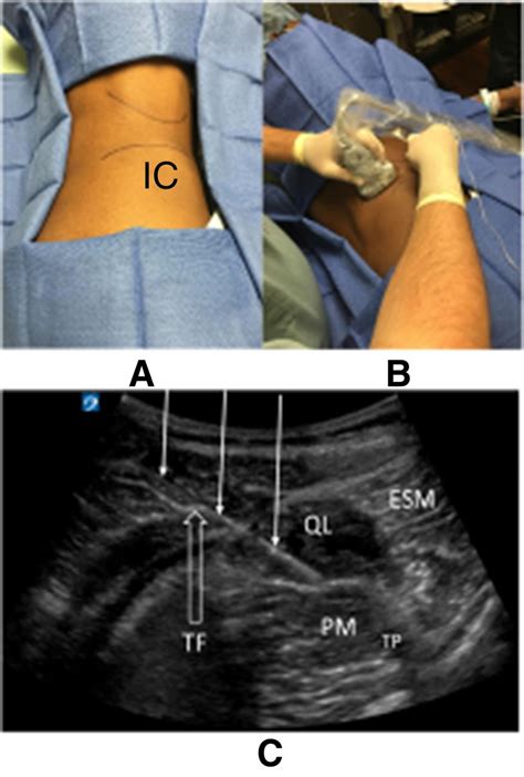 Anterior Quadratus Lumborum Block Analgesia For Total Hip Arthroplasty A Randomized Controlled