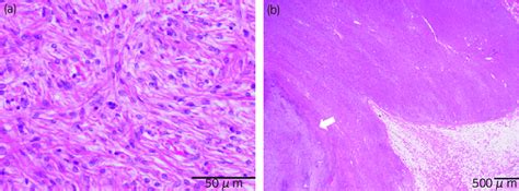 A Diffuse Proliferation Of Spindle And Multi Forming Cells With Large