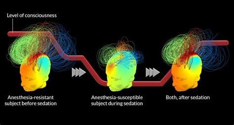 Measuring Brain Waves May Help Predict A Patients Response To