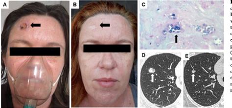Chronic Disseminated Cryptococcosis Without Meningeal Involvement In A