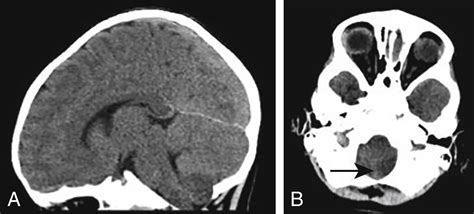 Pediatric Head Ct Radiology Key