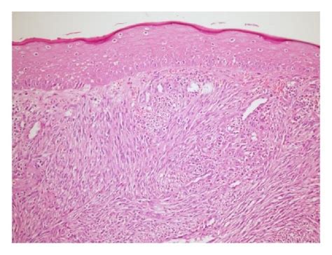 Tumoral Mass Consisting Of Fusiform Cells Under The Surface Epithelium