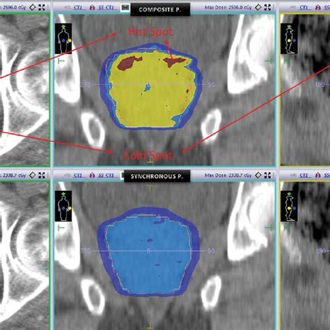 Dose Distributions And Hot Dose Points Of Composite And Synchronous Download Scientific Diagram