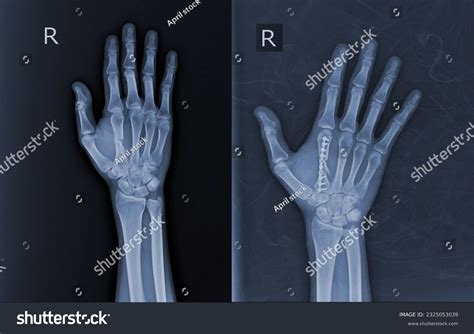 X Ray Showing Plate Fixation 2th Metacarpal Stock Illustration