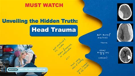Head Trauma Basics Of Head Trauma And Its Radiology Edh Sdh Iph