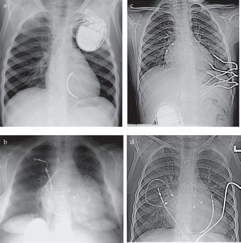 Implantable Cardiac Defibrillator X Ray At Leona Flowers Blog