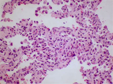 File Non Specfic Interstitial Pneumonia Nsip Cellular Variant 2 