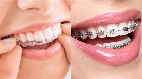 Invisalign O Brackets ¿qué Ortodoncia Es Mejor Para Ti Los Mejores
