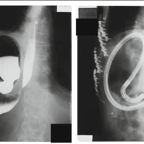 The Upper Gastrointestinal Radiography And The Upper Gastrointestinal