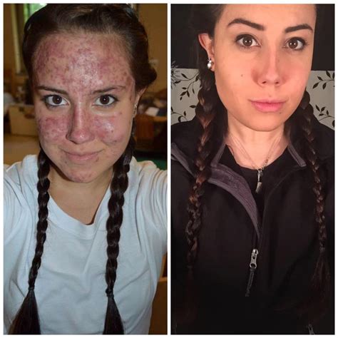 Pyoderma Faciale Rosacea Fulminans Pfrf