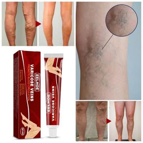 Traitement des Varices pour Les Jambes réduction des varicosités