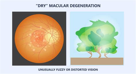 Macular Degeneration Vision