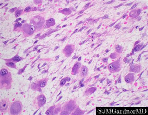 Proliferative Myositis Ganglion Like Jerad Gardner Md Facebook