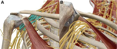 Figure 3 From Pectoralis Minor Syndrome Review Of Pathoanatomy Diagnosis And Management Of
