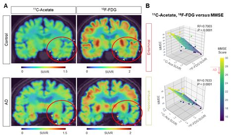 A New Breakthrough In Alzheimers Disease Research Visualizing