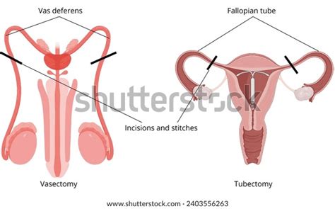 Male Female Sterilization Procedures Vasectomy Tubal Stock Illustration