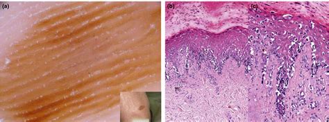 A Dermoscopy Of Acral Melanoma Showing A Parallel Ridge