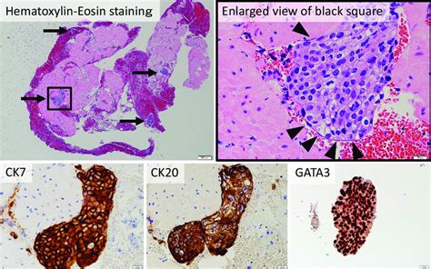The Histopathological Examination Of Eus Fna Specimens Cancer Nests