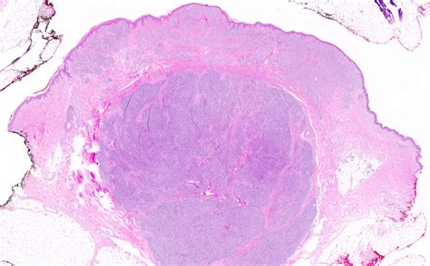 Angiosarcomatous Transdifferentiation Of Metastatic Melanoma Kilsdonk 2020 Journal Of