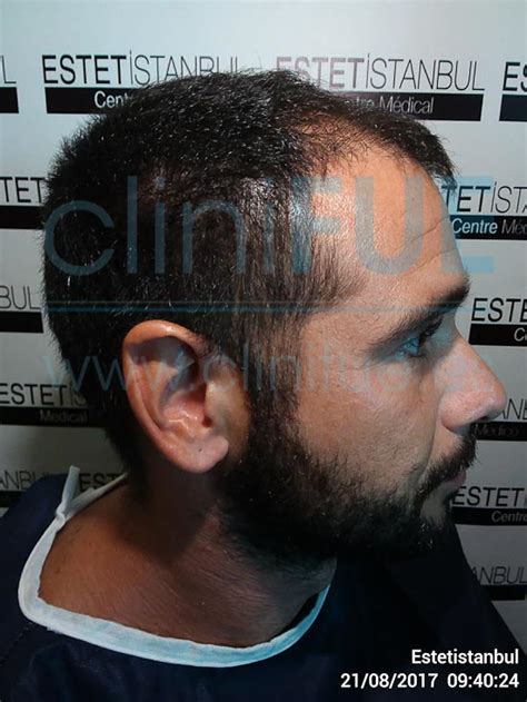Trasplante capilar de Jose 30 Años de Murcia con cliniFUE cliniFUE